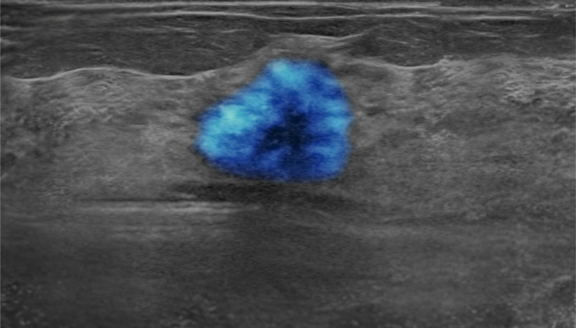 Int-BUS - Breast Ultrasound Cancer Diagnosis AI Solution