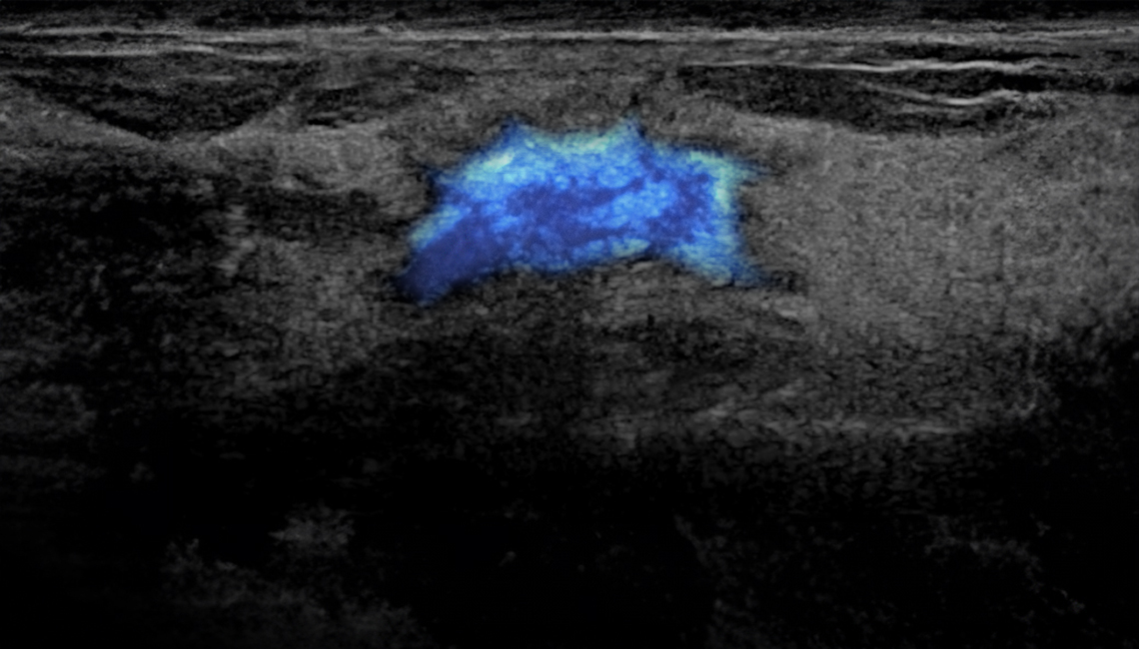 Int-BUS - Breast Ultrasound Cancer Diagnosis AI Solution