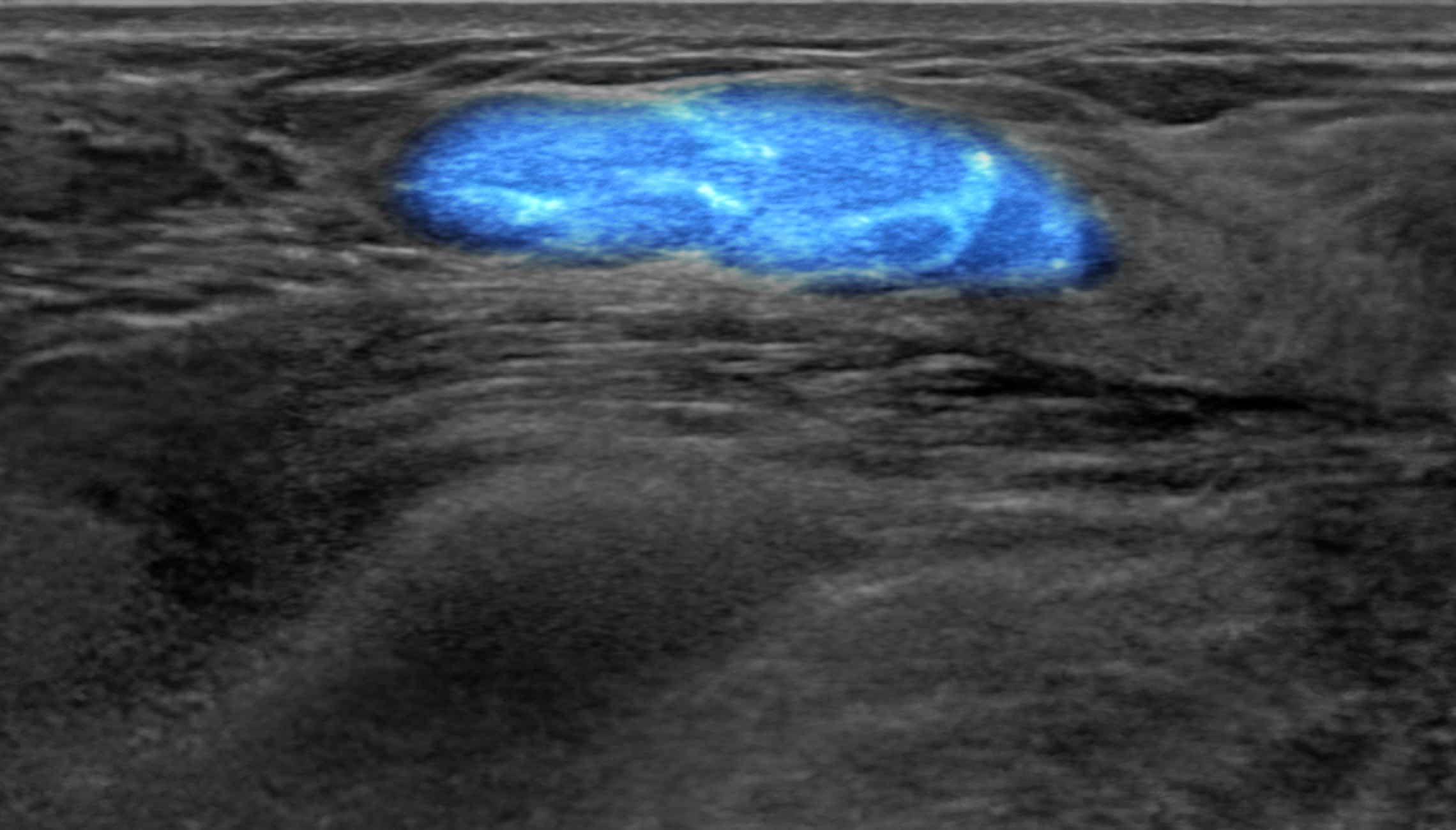 Int-BUS - Breast Ultrasound Cancer Diagnosis AI Solution